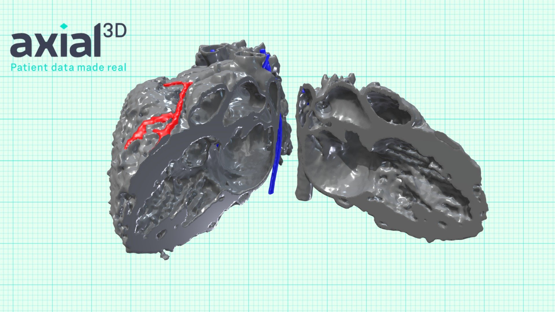 P01837 8NP Myocardium - 3D model by Axial3D [767da82] - Sketchfab
