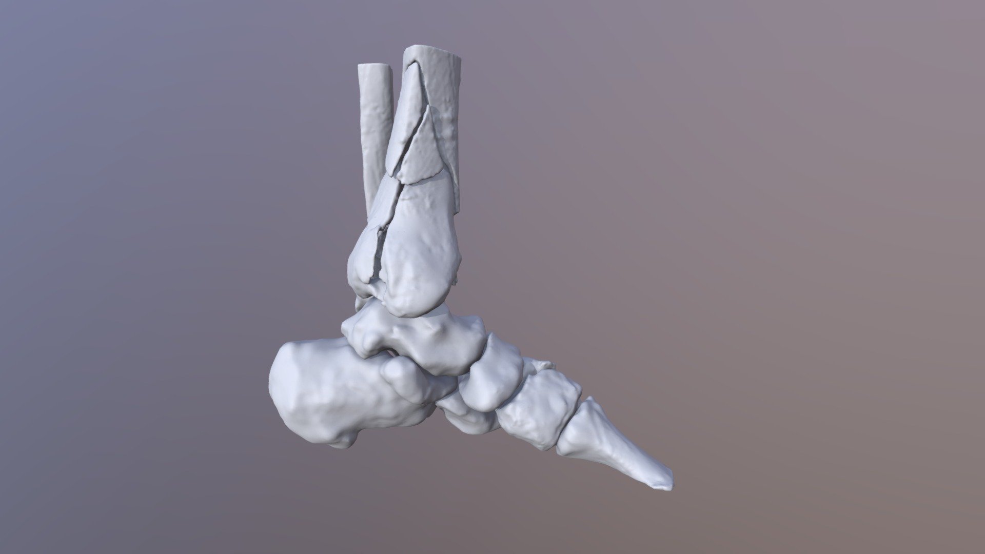 Closed comminuted distal tibia fracture VOKA.IO - 3D model by Innowise ...