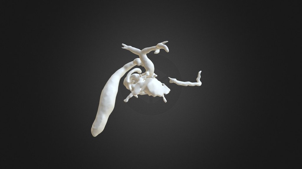 Annular Pancreas with Chronic Pancreatitis - Download Free 3D model by ...