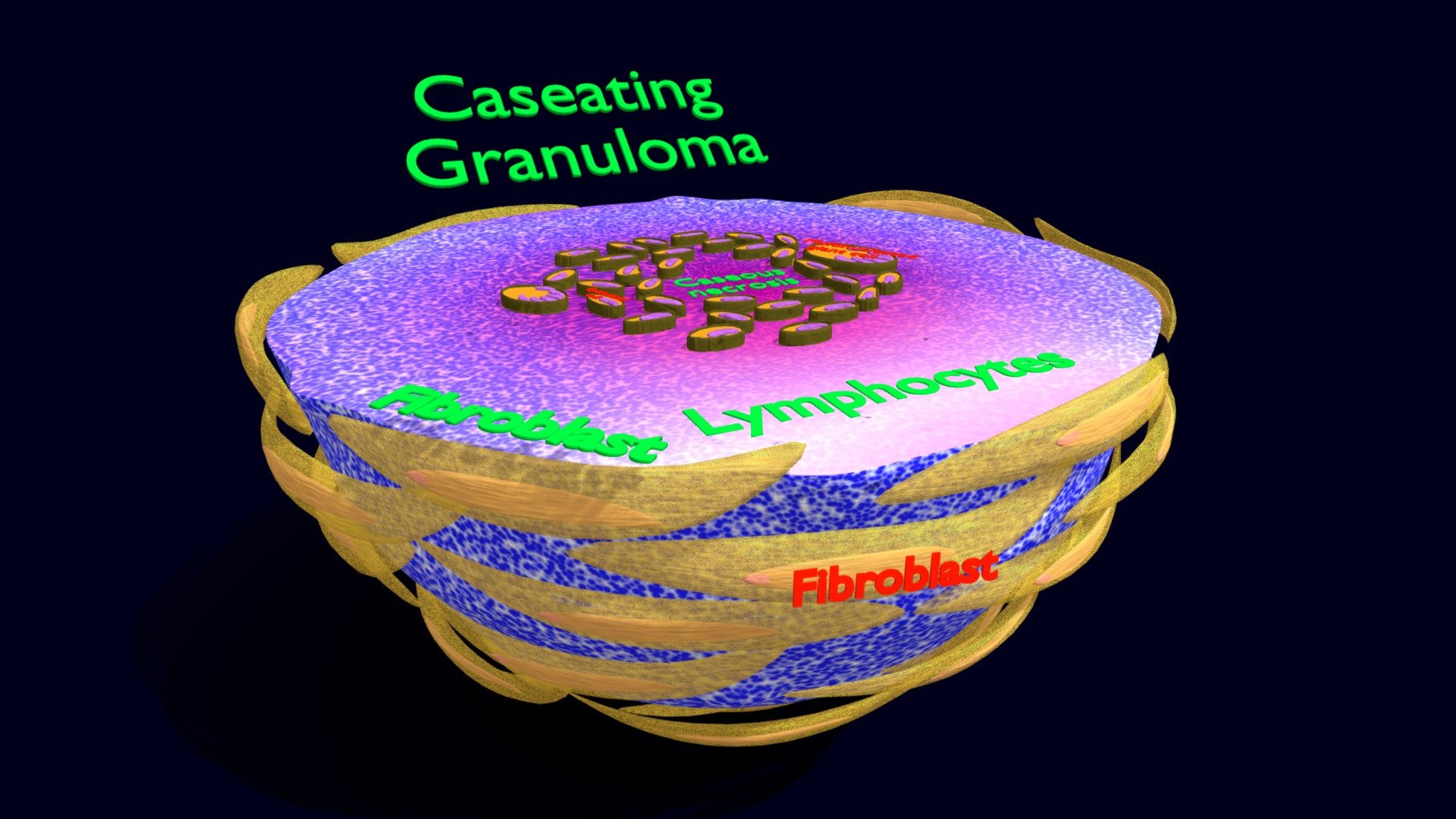 Caseating granuolma tuberculosis labelled - Buy Royalty Free 3D model ...