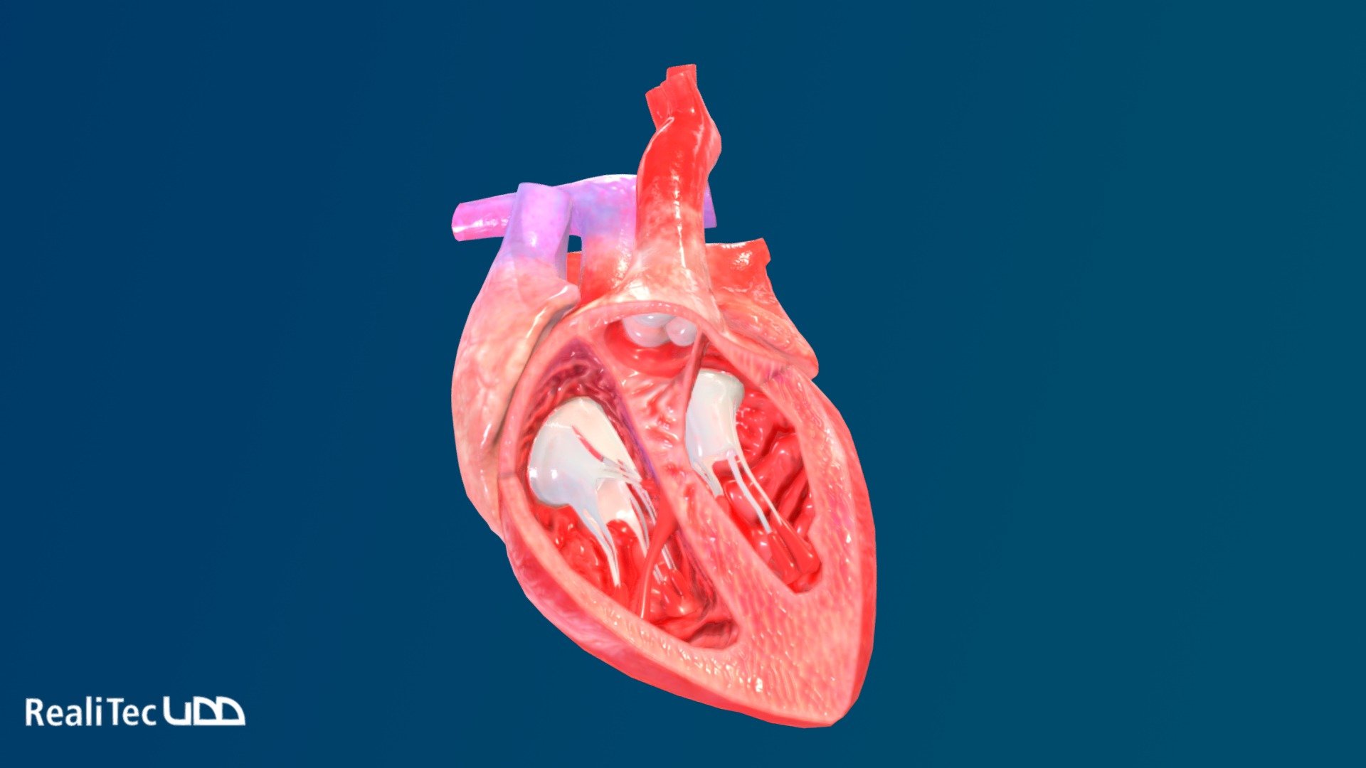 Transposición de grandes arterias (TGA) - 3D model by UDD - Centro de ...