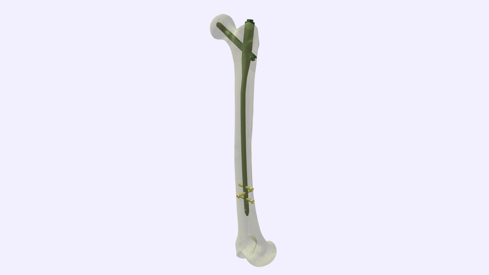 Proximal Femoral γ-Nail (γ-PFN)-Long version - 3D model by OSTEOMED-M ...