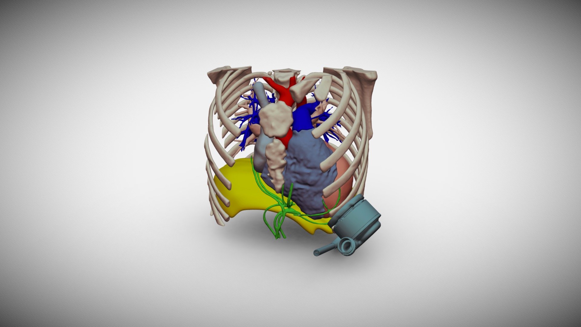HM3 in congenital v2 - 3D model by Imre J. Barabás, MD, M.Sc ...