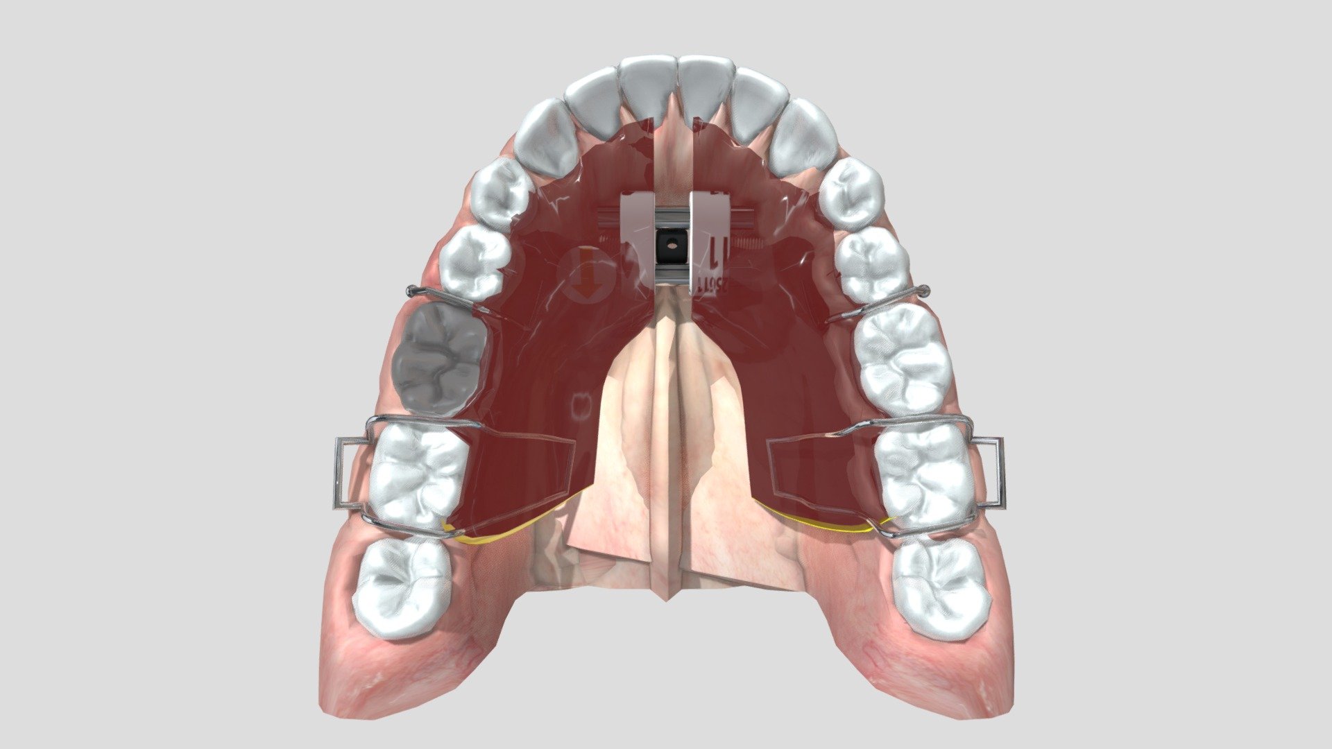 3-removeable-mandibular-expander - 3D model by Holos Studios [799fec1 ...