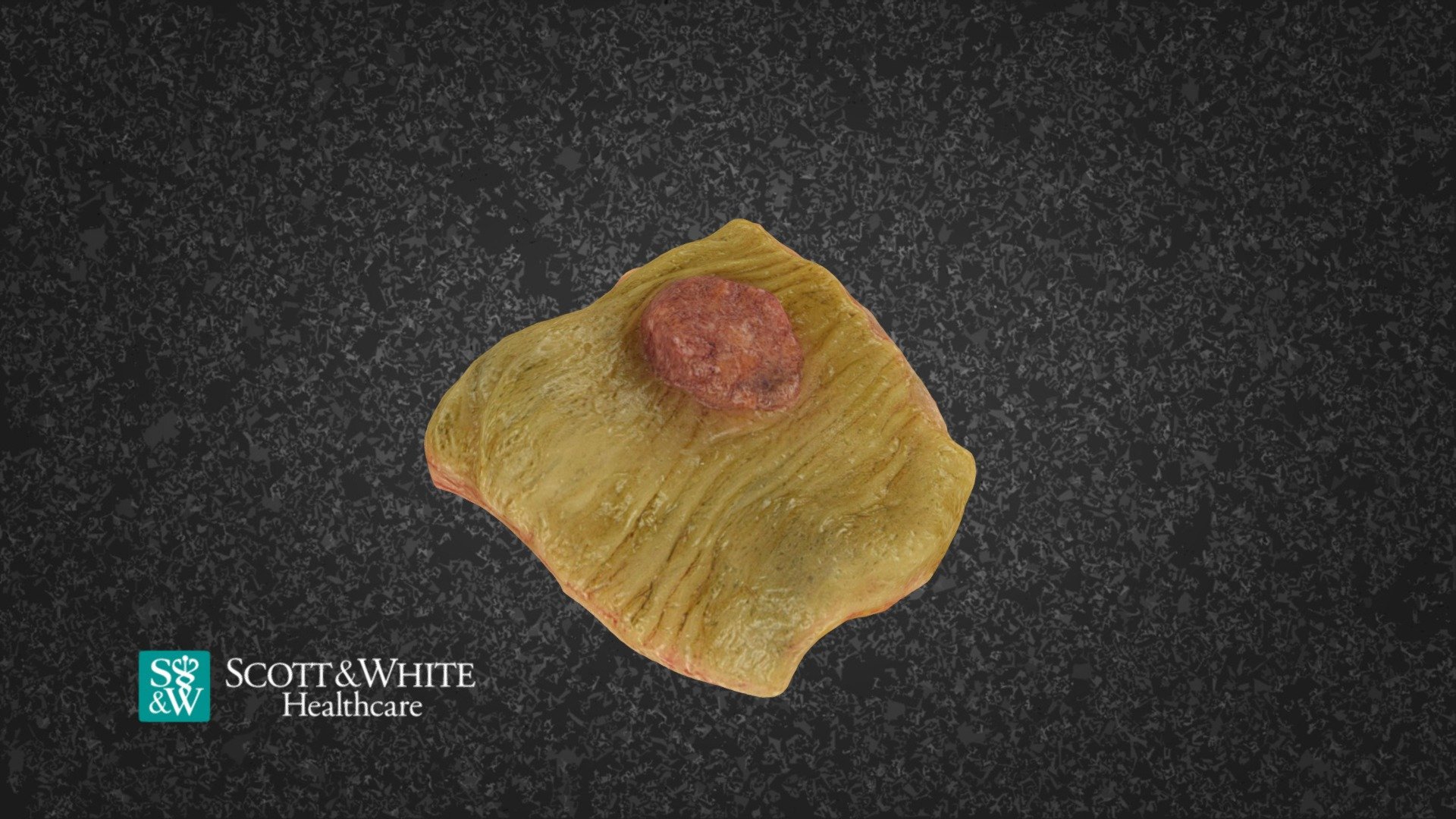 Sessile Polypoid Mass - 61761 - 3D model by Scott & White Moulage ...