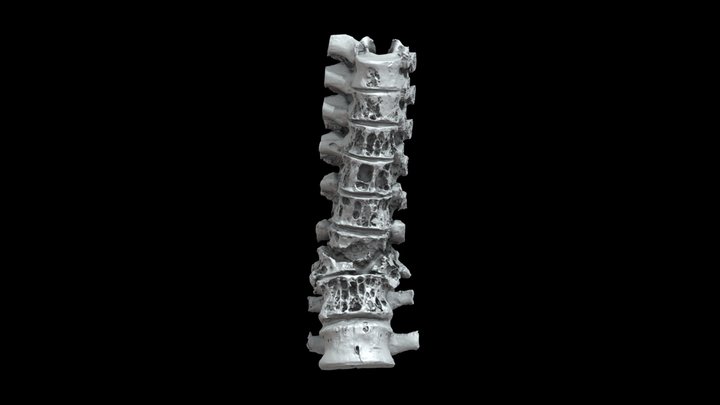 Tuberculosis 3D models - Sketchfab