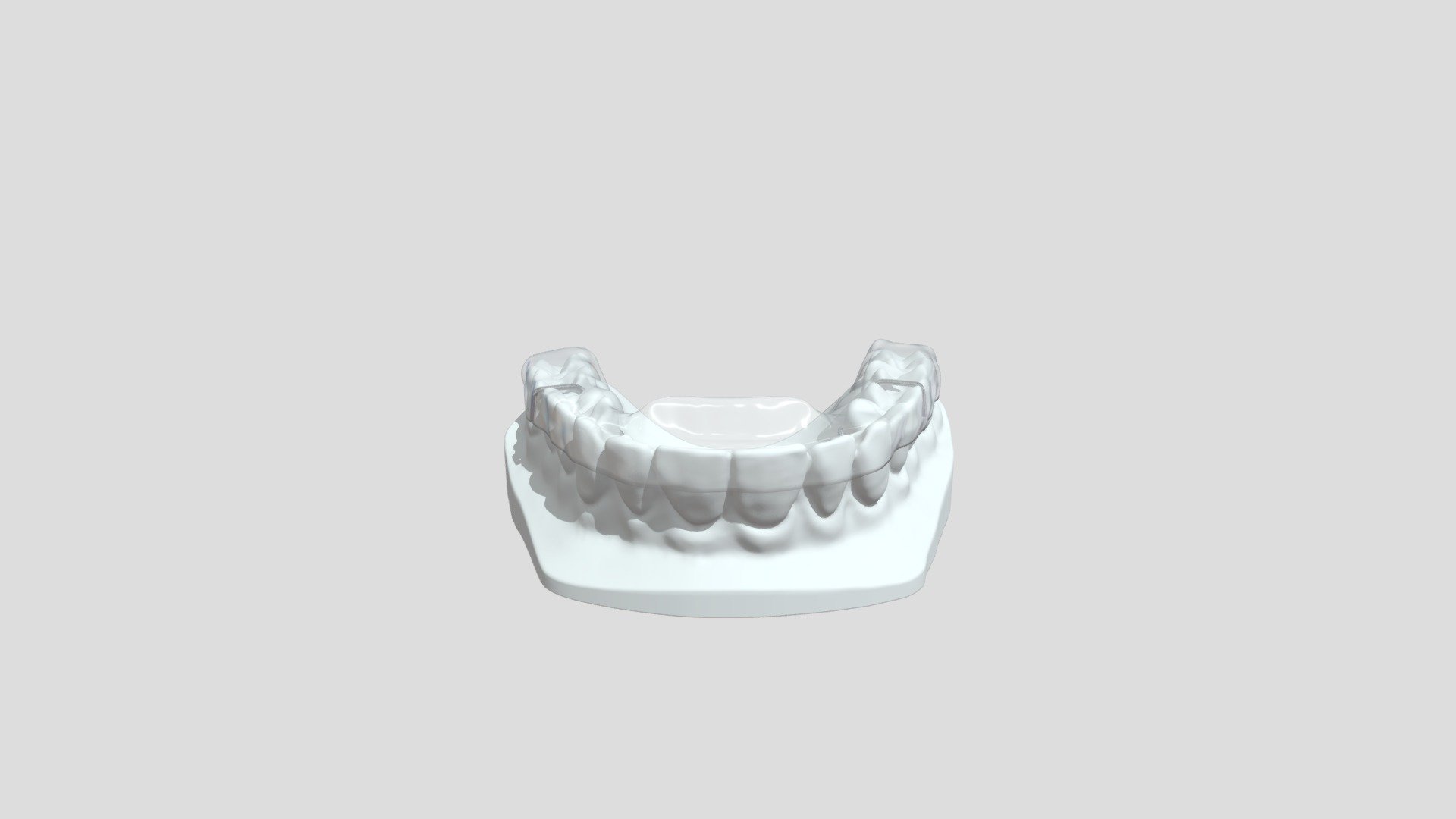 Anterior Repositioning Splint - 3D model by ODL OrthoLab (@Odlortho ...
