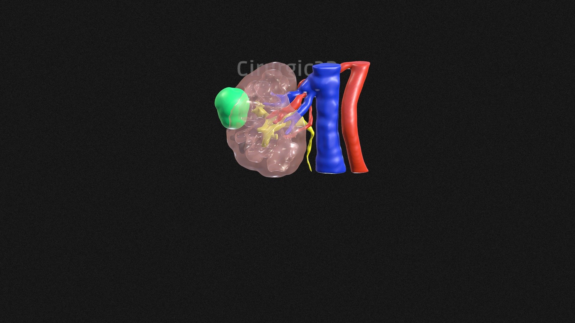 Kidney tumor - Download Free 3D model by Cirurgic3D (@neorenal ...