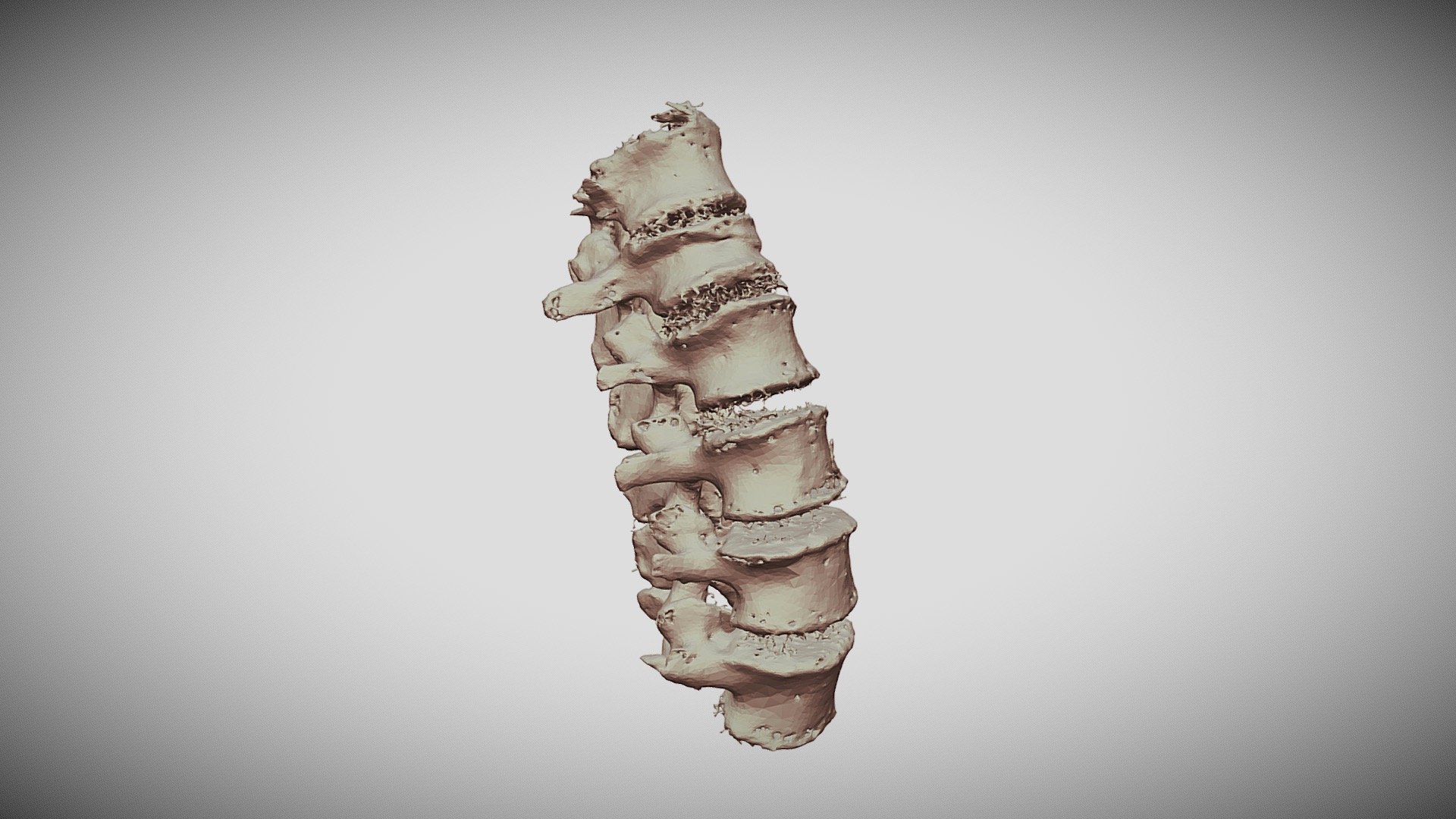AOspine_Thoracolumbar_TypeA3_L1 - 3D model by E_Schulz [7b5123f ...