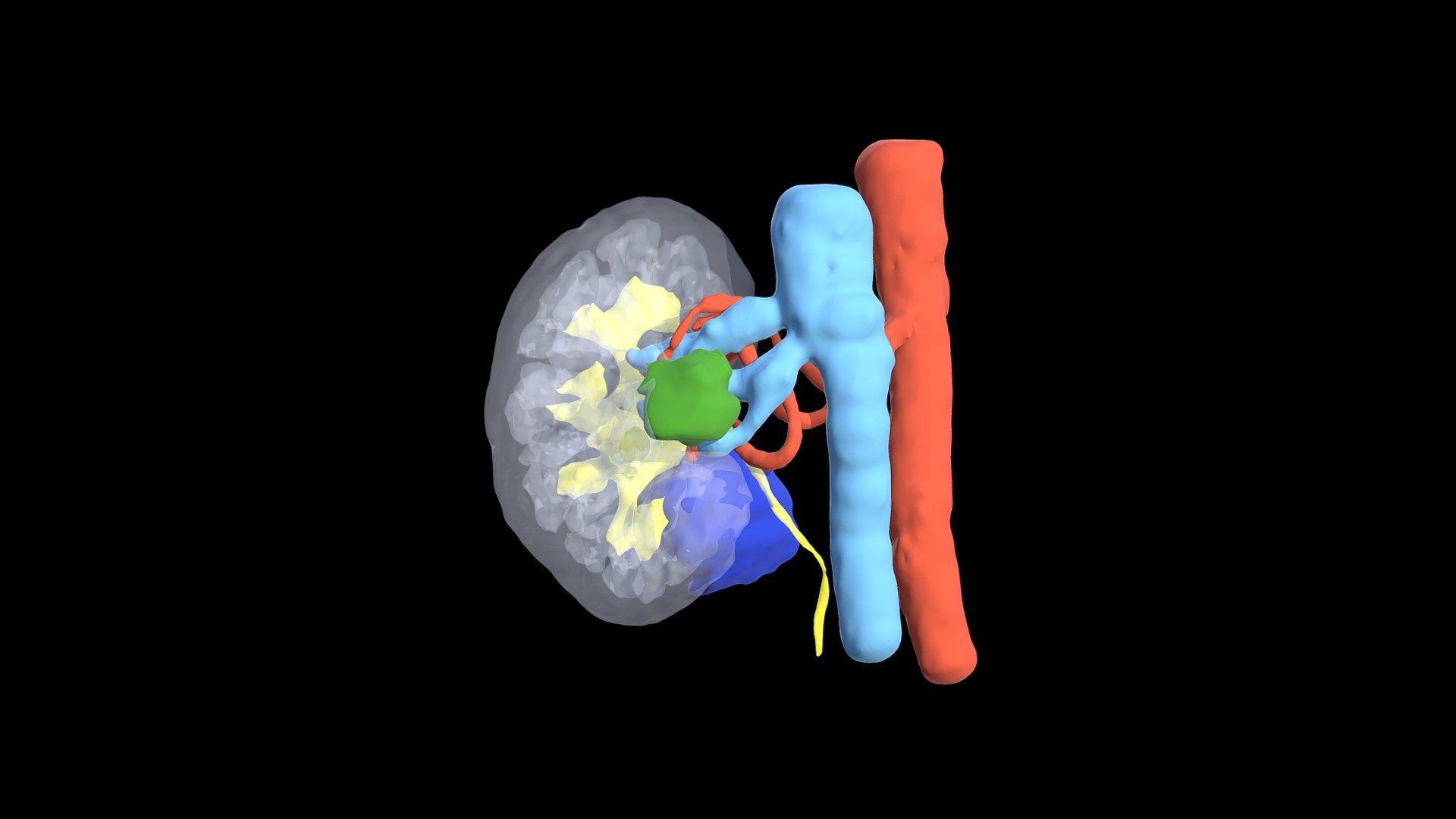 Right Renal Tumor - 3D model by Cirurgic3D (@neorenal) [7b7886f ...