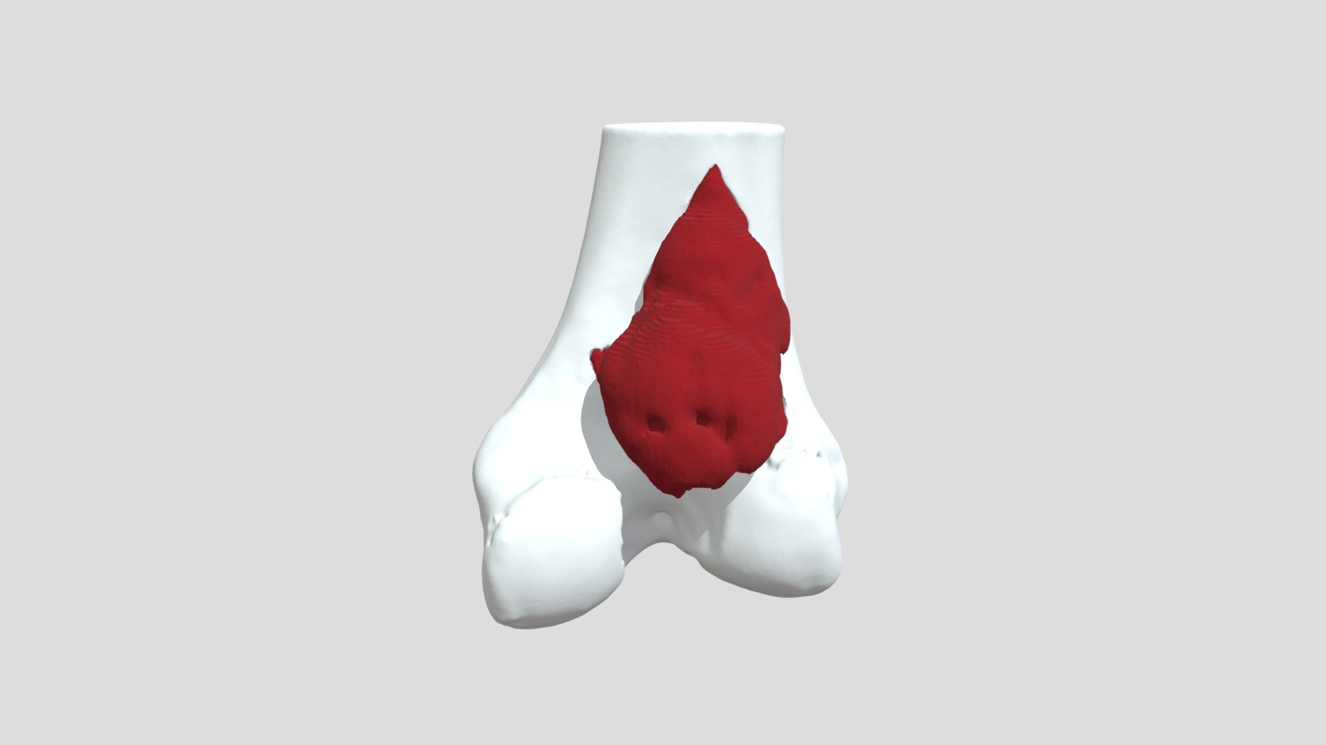Osteosarcoma - 3D model by fpaulano [7bc71c9] - Sketchfab