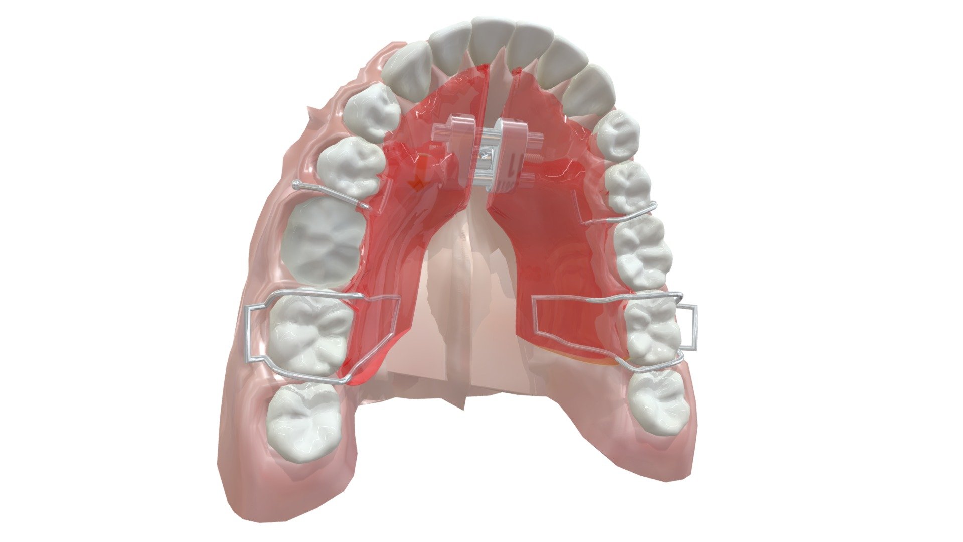 3. REMOVEABLE MANDIBULAR EXPANDER - 3D model by Interactive 3D Data ...