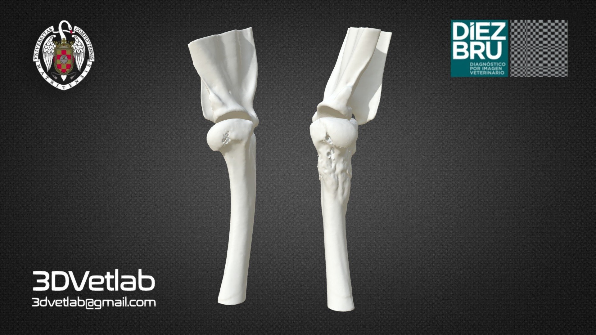 Osteosarcoma (humerus) - 3D model by GAIA Biomodels (@GaiaBiomodels ...