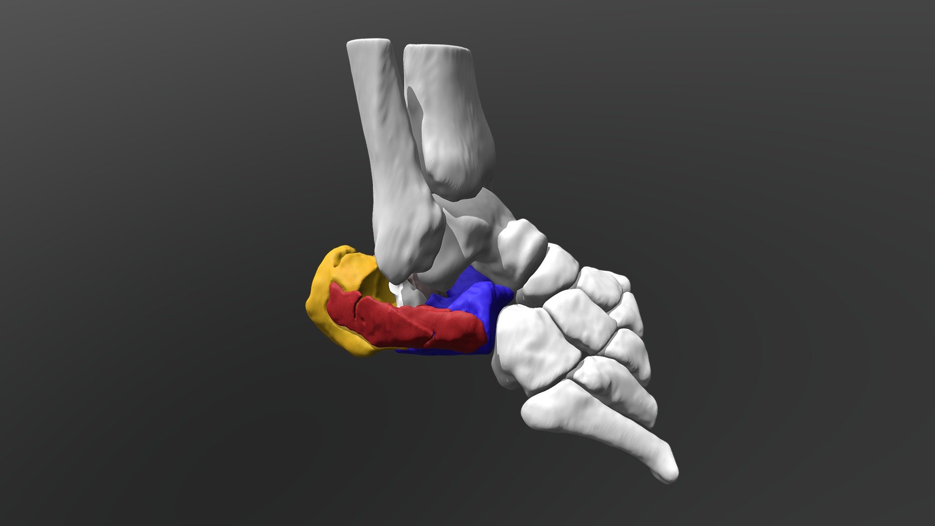 Compression fracture of the Calcaneus, 784 - 3D model by valchanov ...
