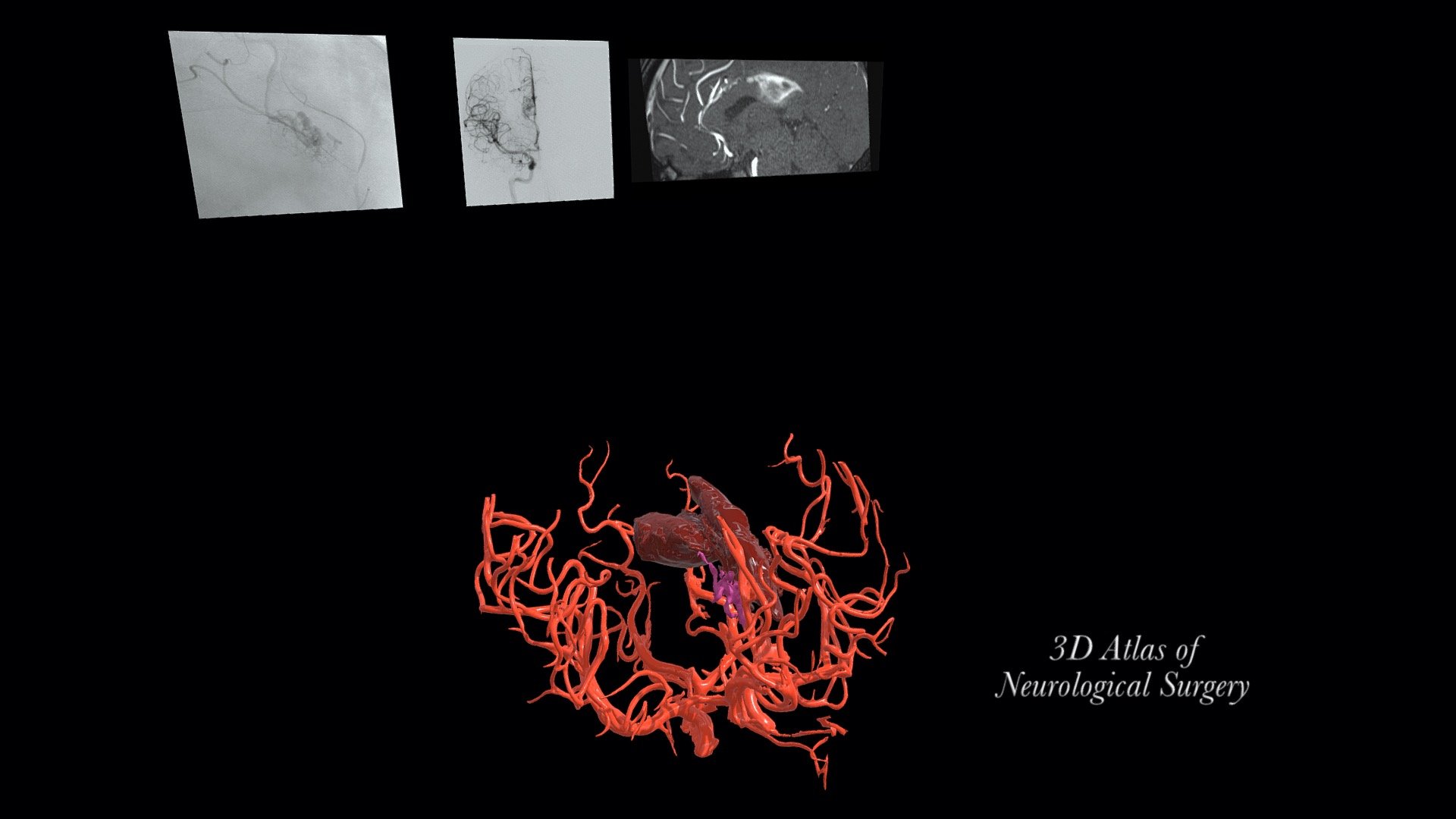 Pericallosal AVM - 3D model by 3D Atlas of Neurological Surgery ...