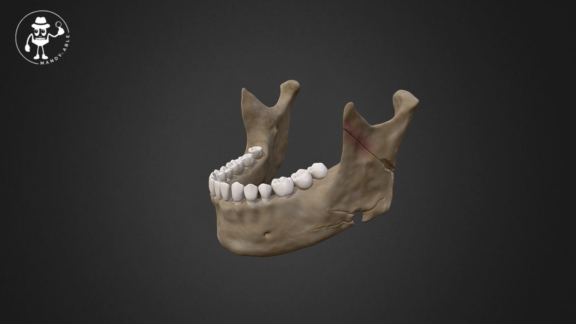 Perimortem trauma - 3D model by Doha Abualhija (@mandibleid) [7f238a9 ...