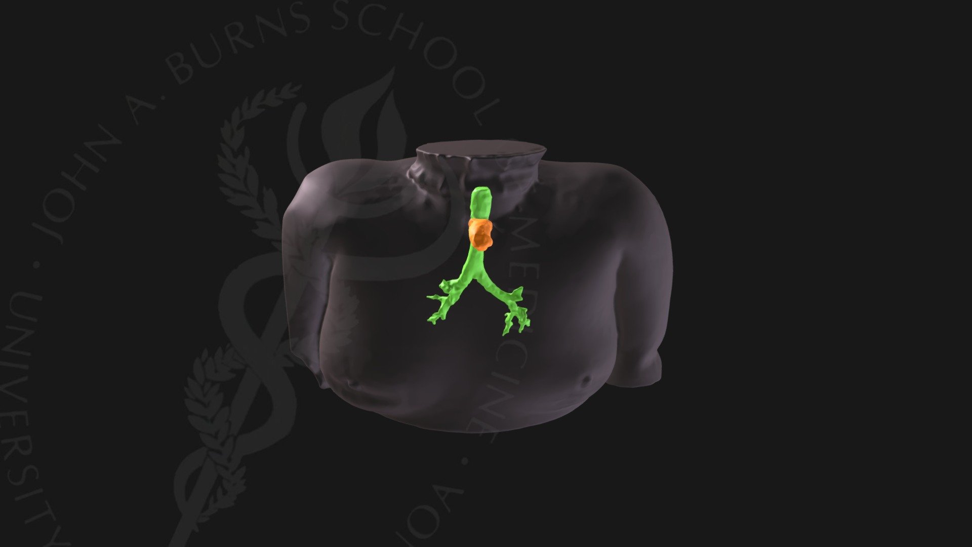 Tracheostomy 2389 - 3D model by John A Burns School of Medicine ...