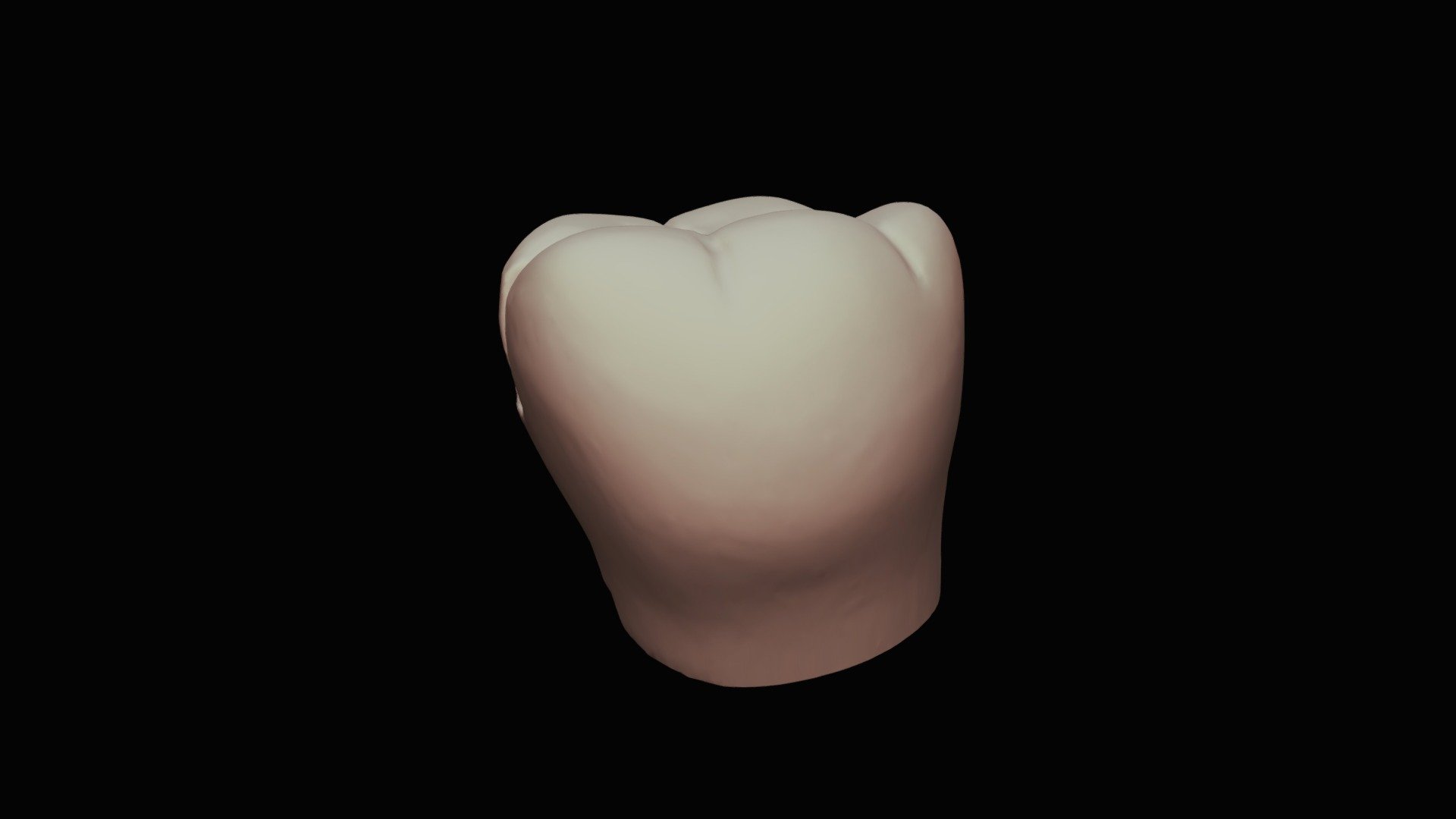 Class II MO #19 - 3D model by VCU - Restorative Dentistry (@sodgp ...