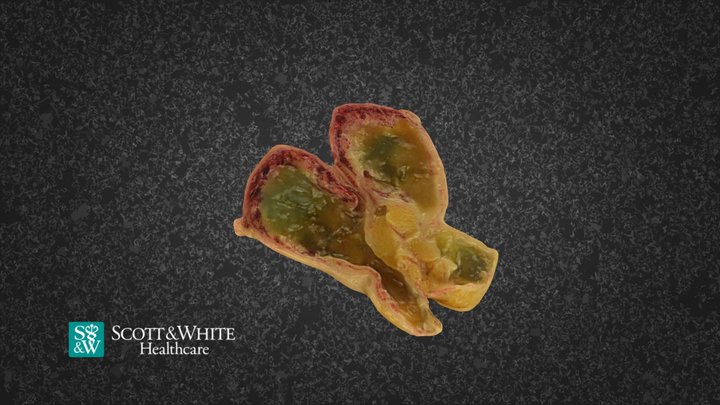 Appendicitis 3D models - Sketchfab