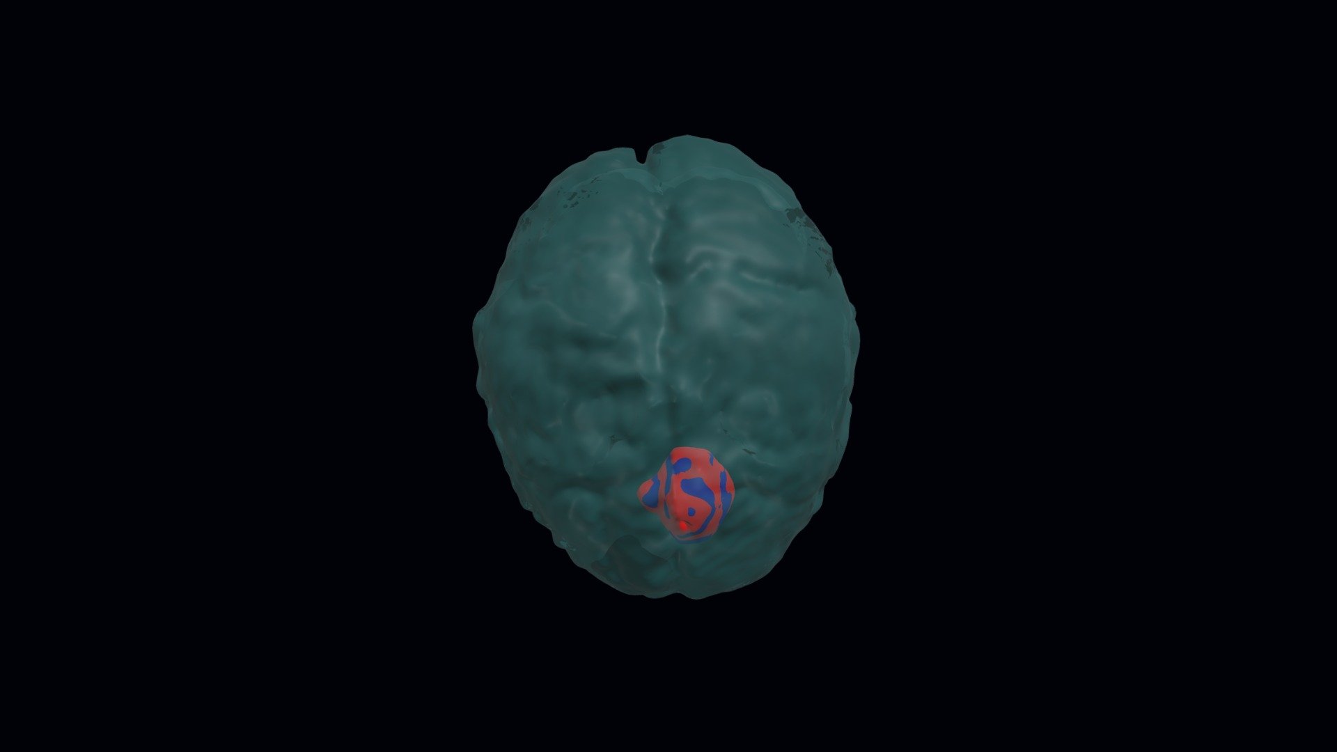 Brain Tumor Obj - Download Free 3D model by tvalerio [8017adc] - Sketchfab