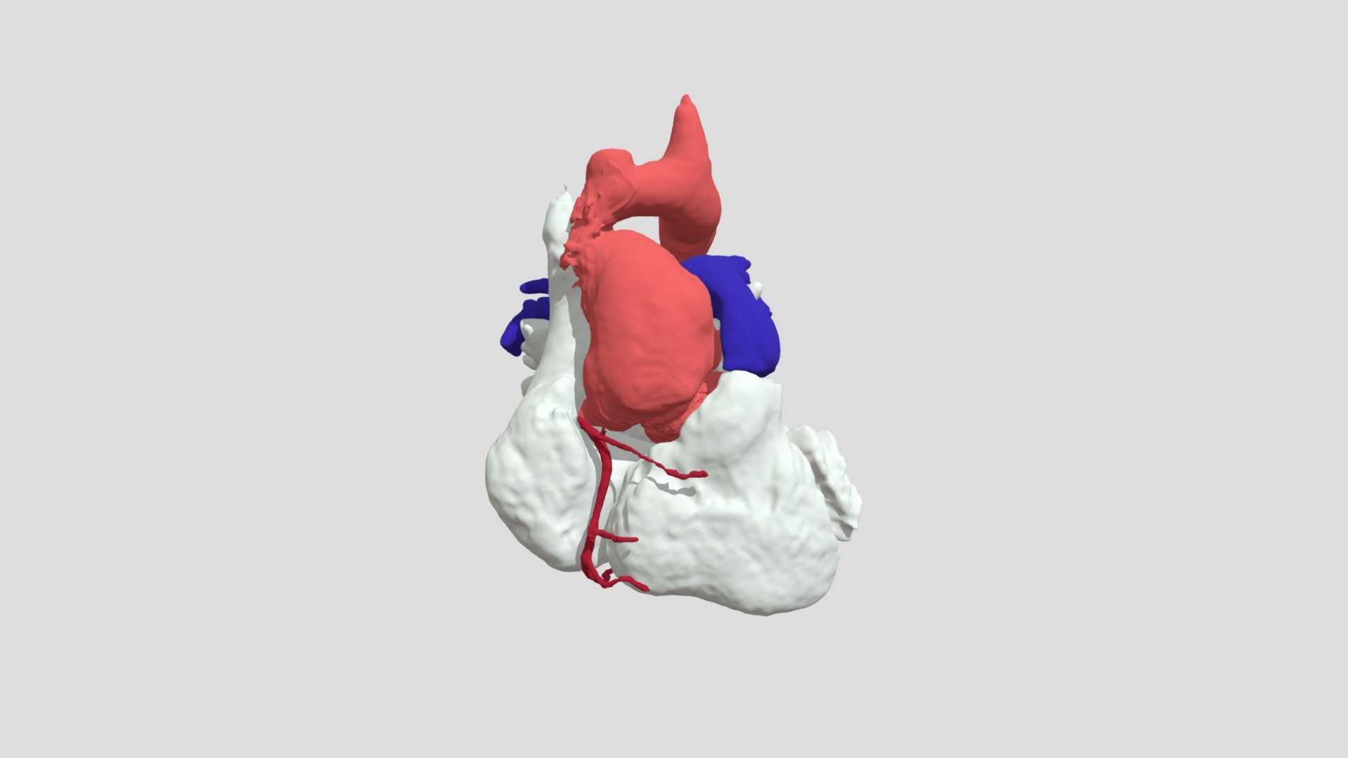 Aortic Stenosis (S0333) - 3D model by NCHS Cardiac Advanced Projects ...