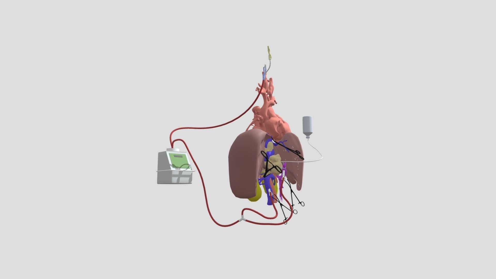 Right hepatectomy with veno-venous bypass - 3D model by Denys.F ...