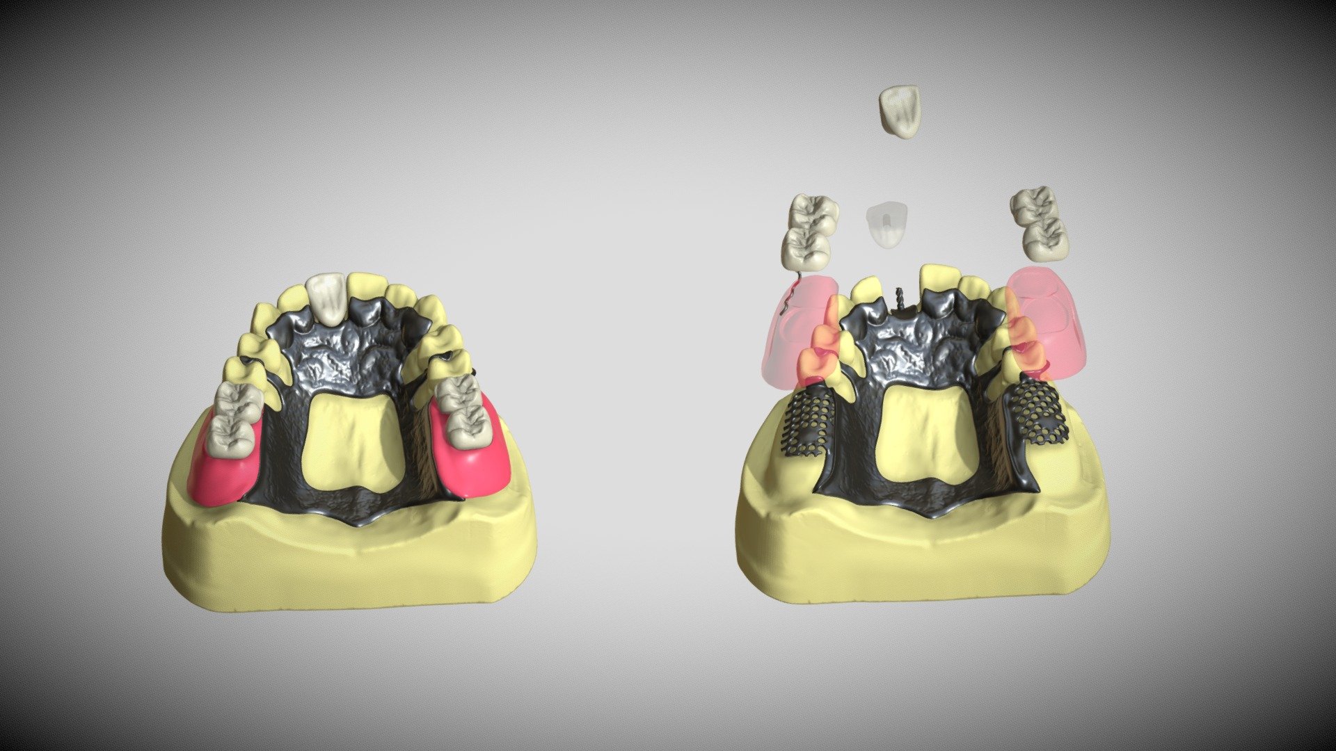 Kennedy Class I Mod 1 Design (Maxillary) - 3D model by Muhammad Nabeel ...