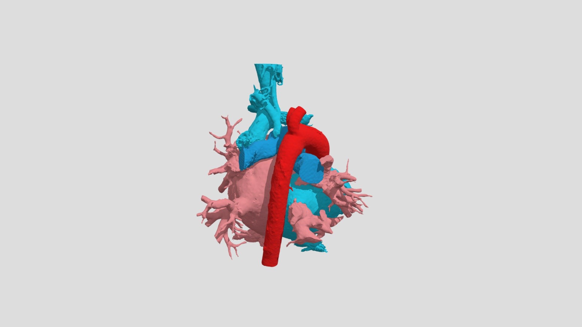 Interrupted IVC, Ipsilateral PV (S0309) - 3D model by NCHS Cardiac ...