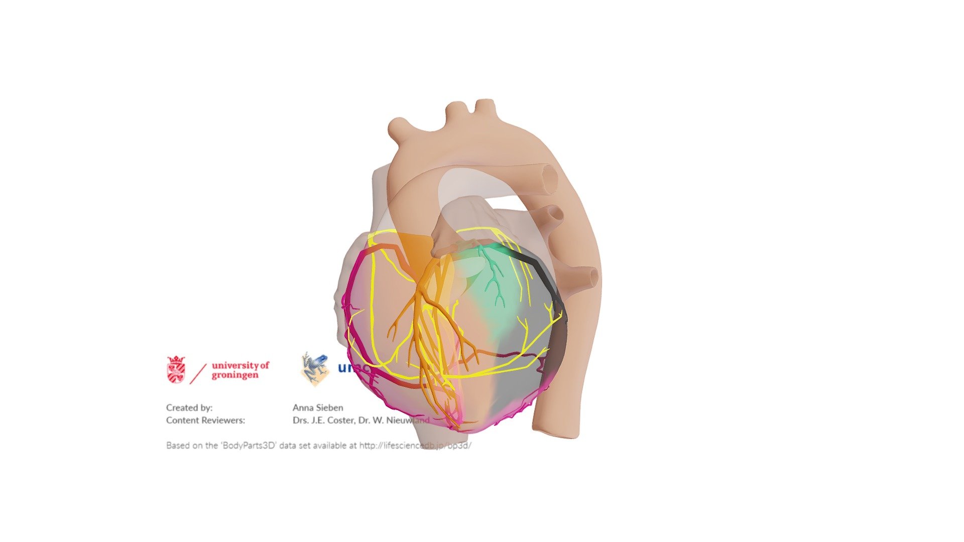 Proximaal Circumflex Arterie (CX) Infarct - Download Free 3D model by E ...