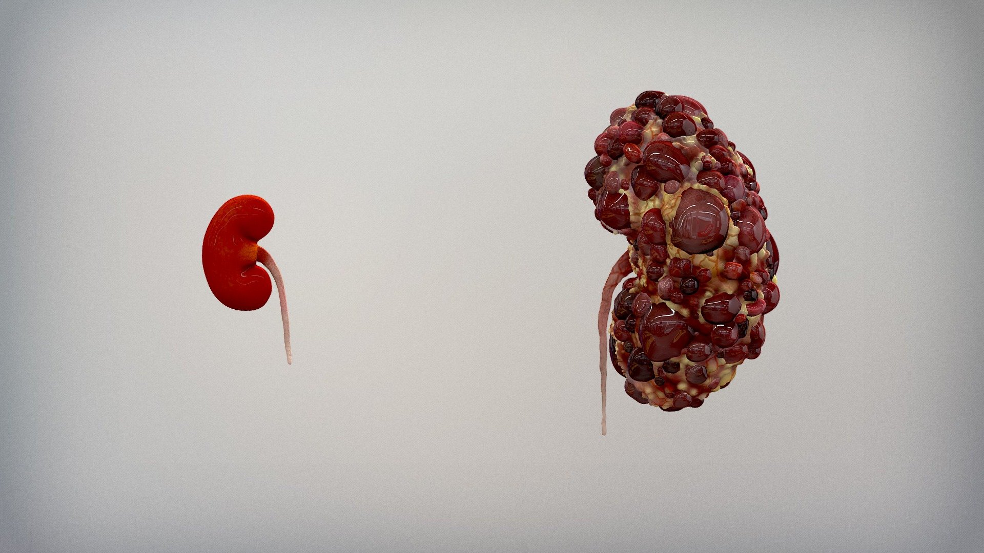 The Anatomy of Polycystic Kidney Disease (ADPKD) - Download Free 3D ...