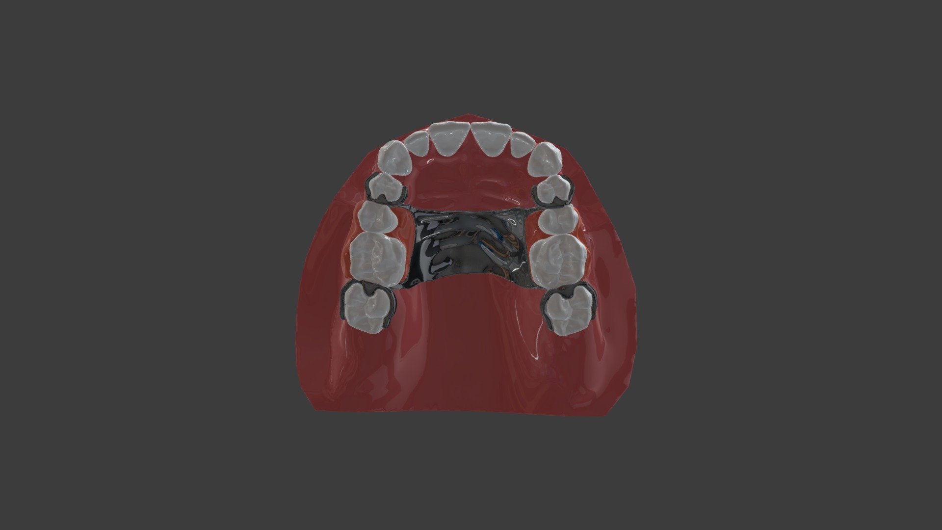 Maxillary RPD Class 3 - 3D model by Ahmed Mahrous (@drahedmahrous ...