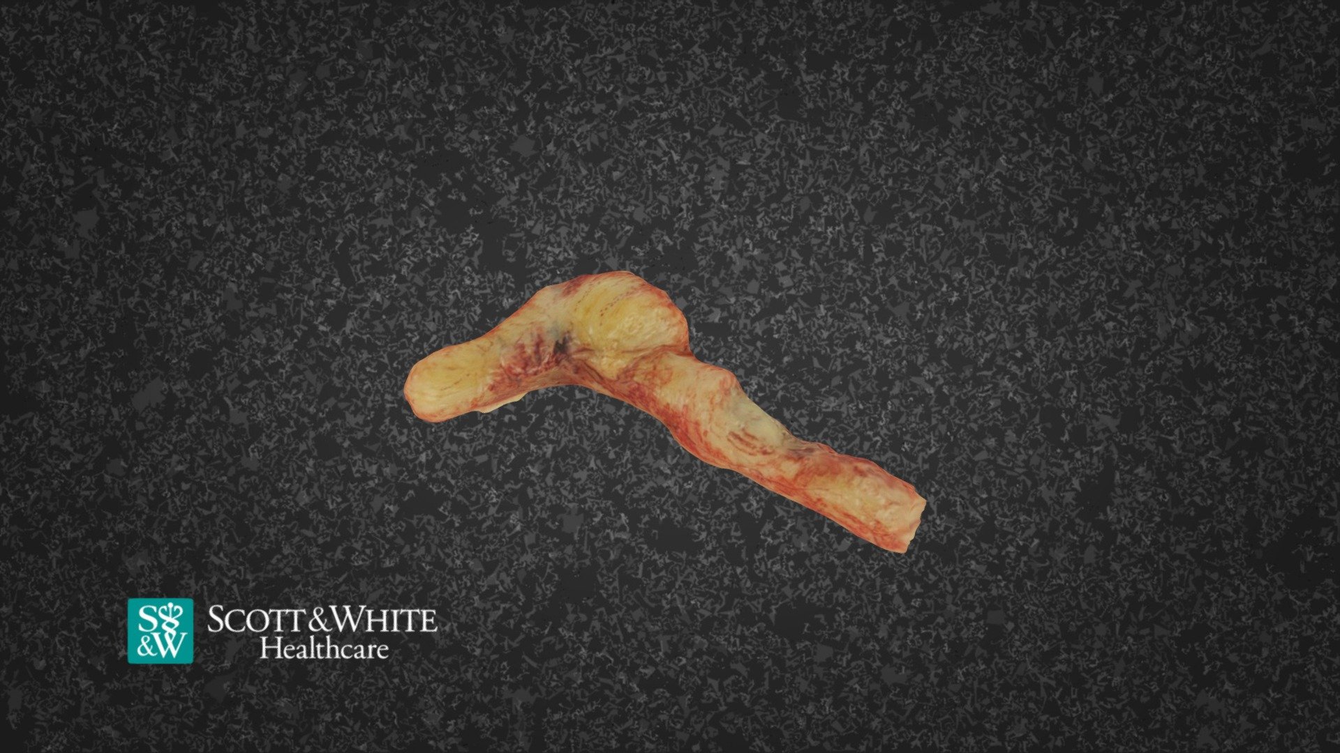 Acute Appendicitis 120043 - 3D model by Scott & White Moulage Project ...