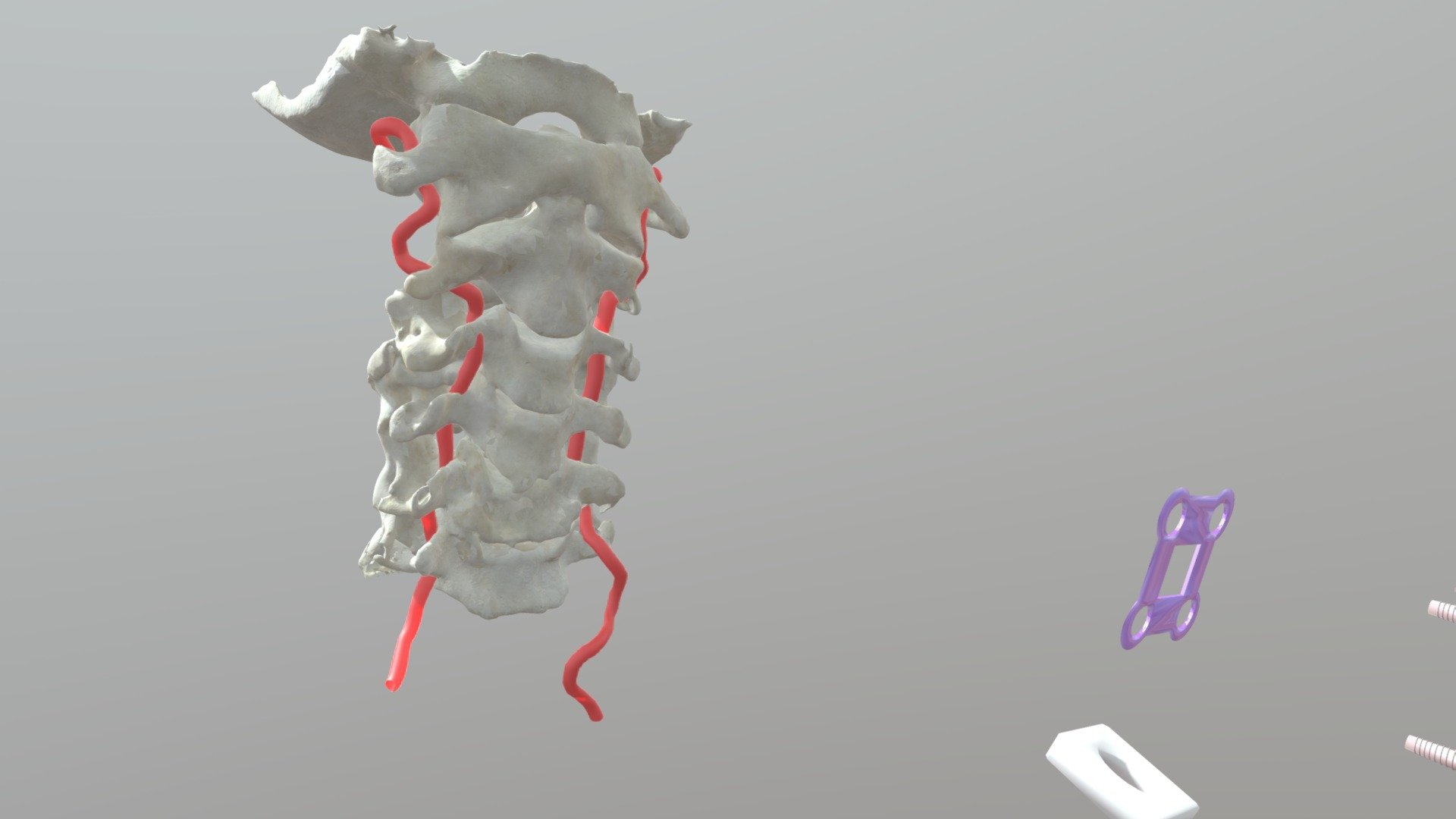 ACDF 1 - 3D model by walshlab [8420344] - Sketchfab