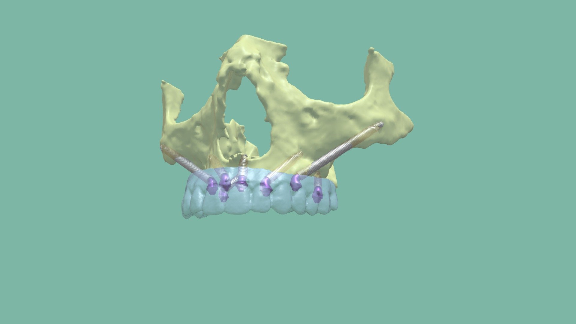 VC Dr Vanderlim 2 - 3D model by Cirurgiaguiada.net (@leandroperussolo ...