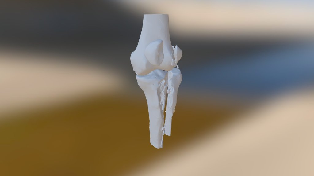 Knee - Proximal Tibia Fracture sku 028 - 3D model by orto3d [84412d8 ...
