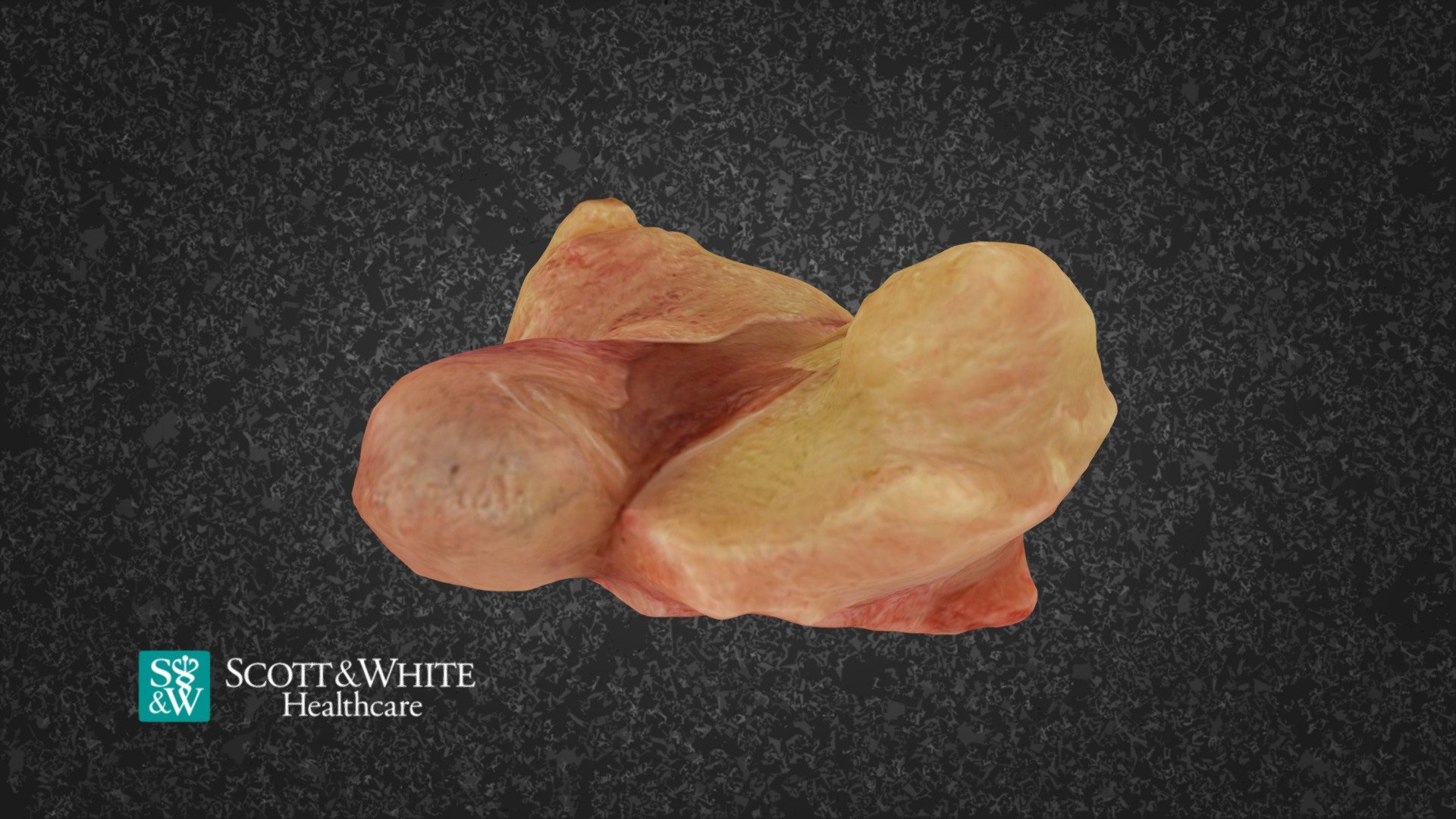 Multiple Fibromyomas Uterus 144674 - 3D model by Scott & White Moulage ...