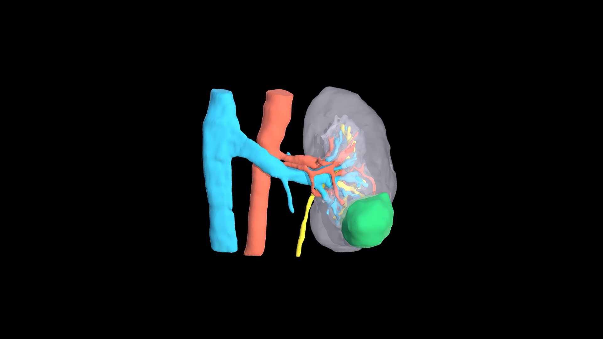 Left Renal Tumor - 3D model by Cirurgic3D (@neorenal) [850ee83] - Sketchfab