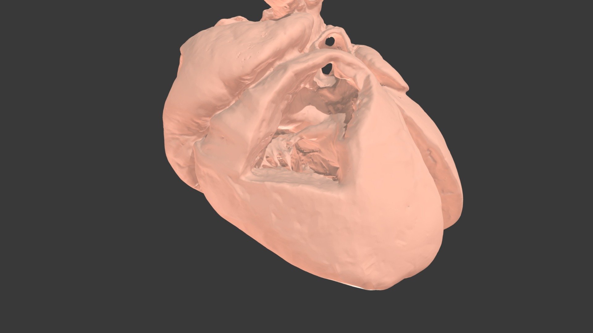 ASD #3 - Polysplenia, {S,D,S} with ASD 2, PDA - 3D model by heartmodels ...