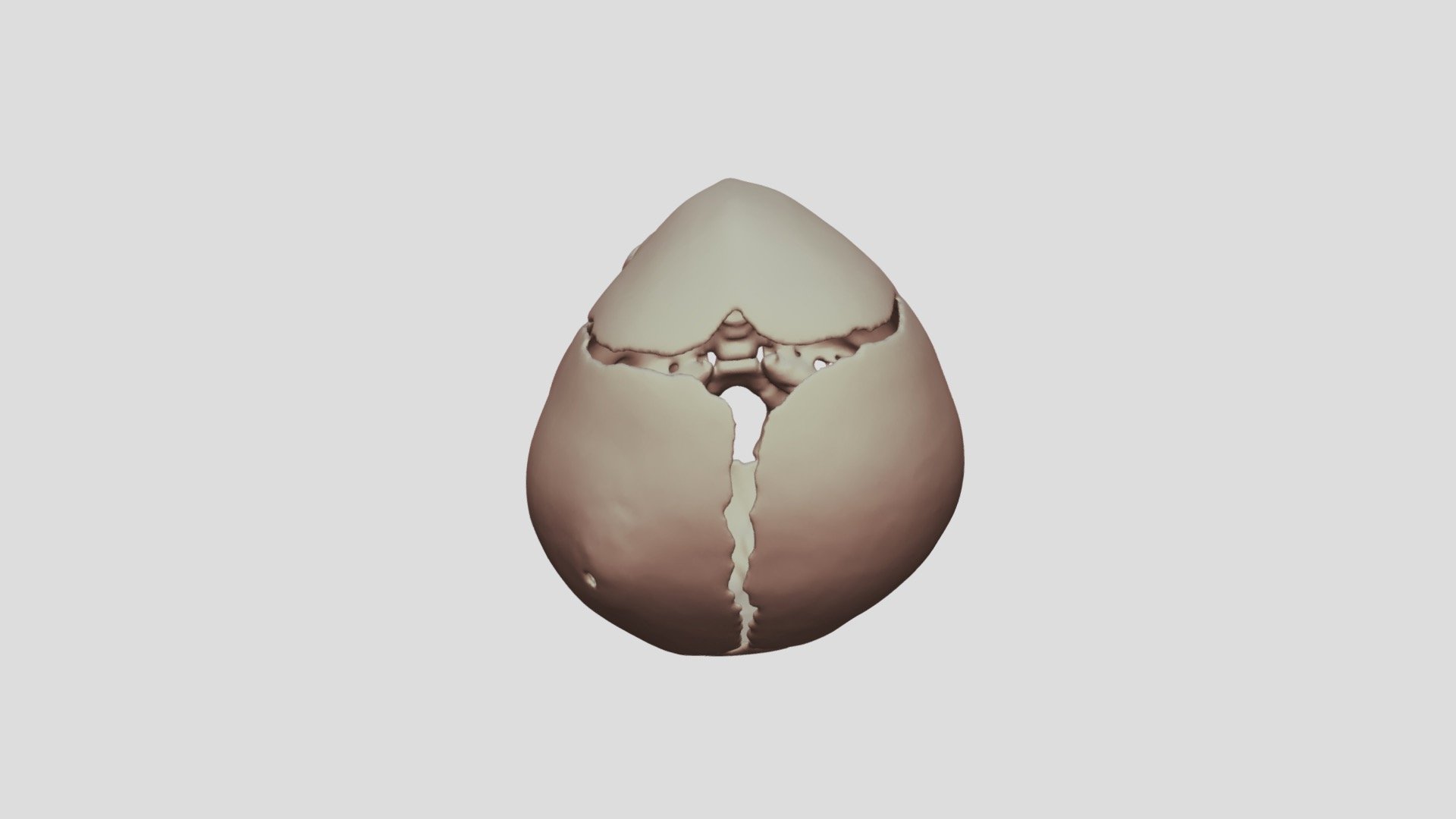 Metopic Craniosynostosis - 3D model by nascene [85f72d4] - Sketchfab