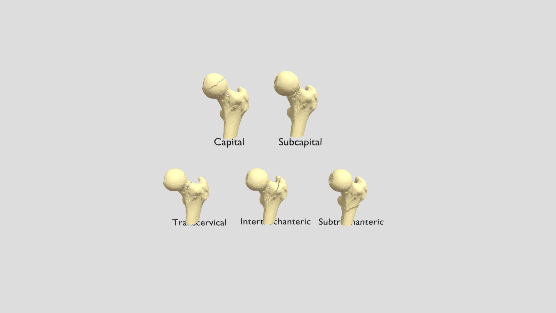 Neck of femur fractures - 3D model by VivekAnatomy [864b07b] - Sketchfab