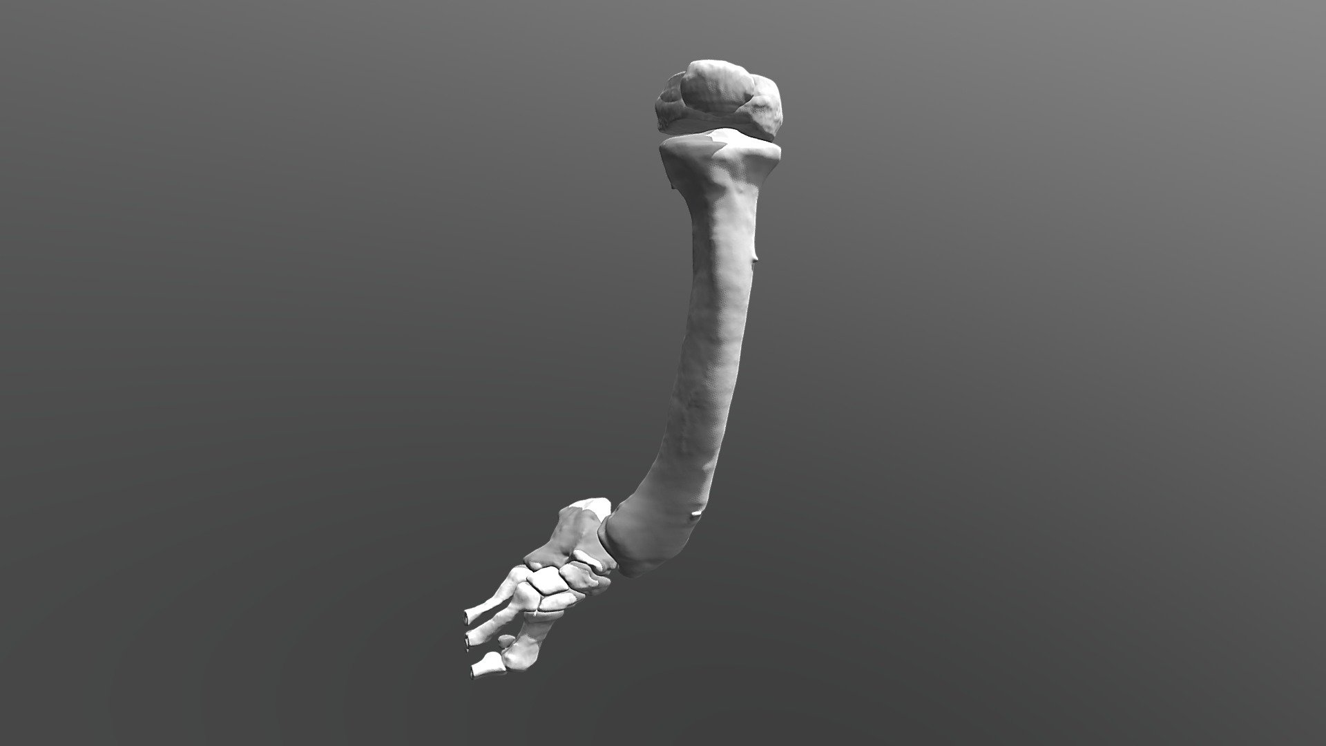 Malformation of the ankle - talipes varus - 3D model by valchanov ...