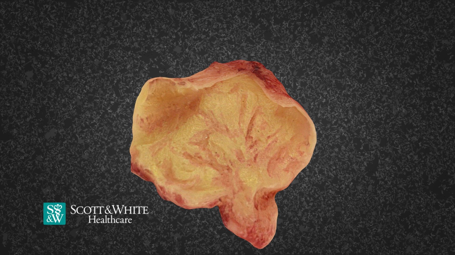 Gallbladder 160786 - 3D model by Scott & White Moulage Project ...