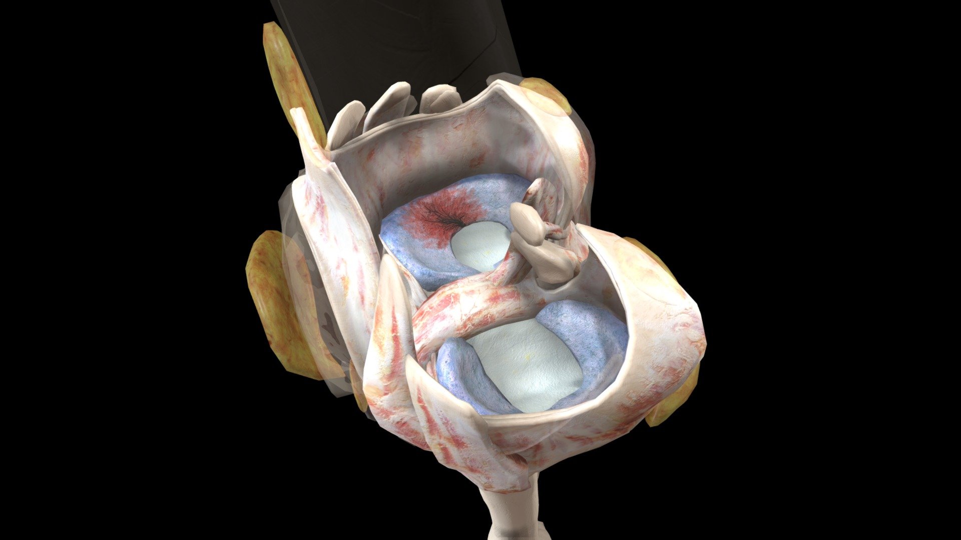 Lateral Meniscus: Radial Tear - 3D model by IUI University Library ...