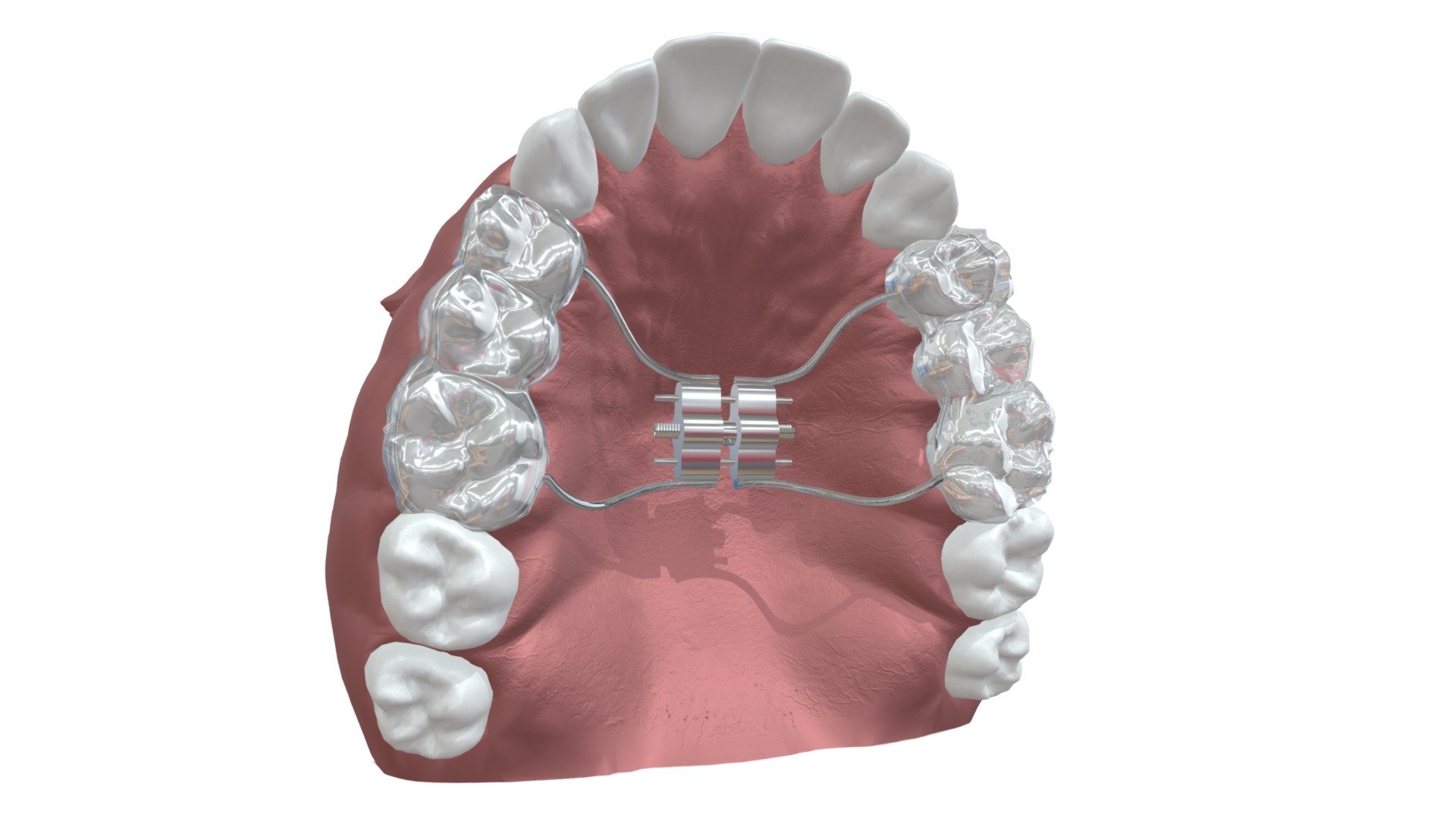 Rapid Palatal Expander (RPE) - Bonded Type - 3D model by Interactive 3D ...