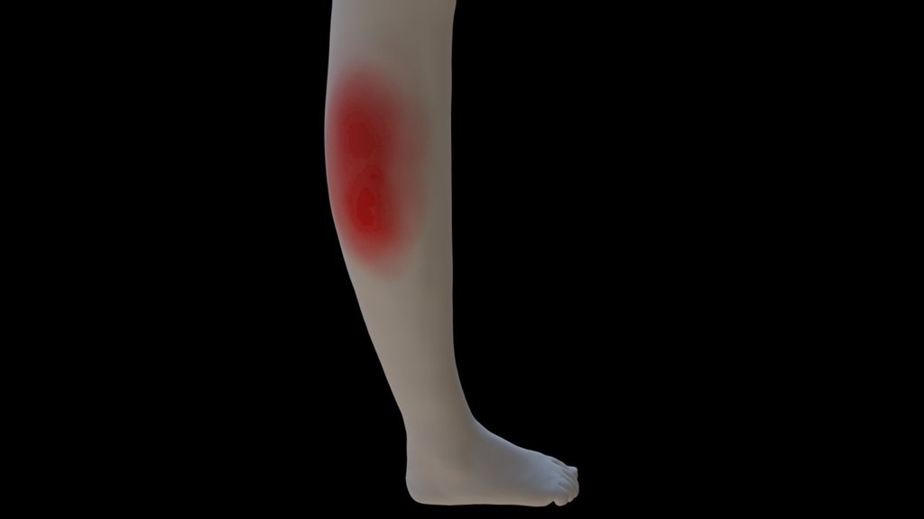 # 049 Bone Cancer Leg - 3D model by makerof3d [89712db] - Sketchfab