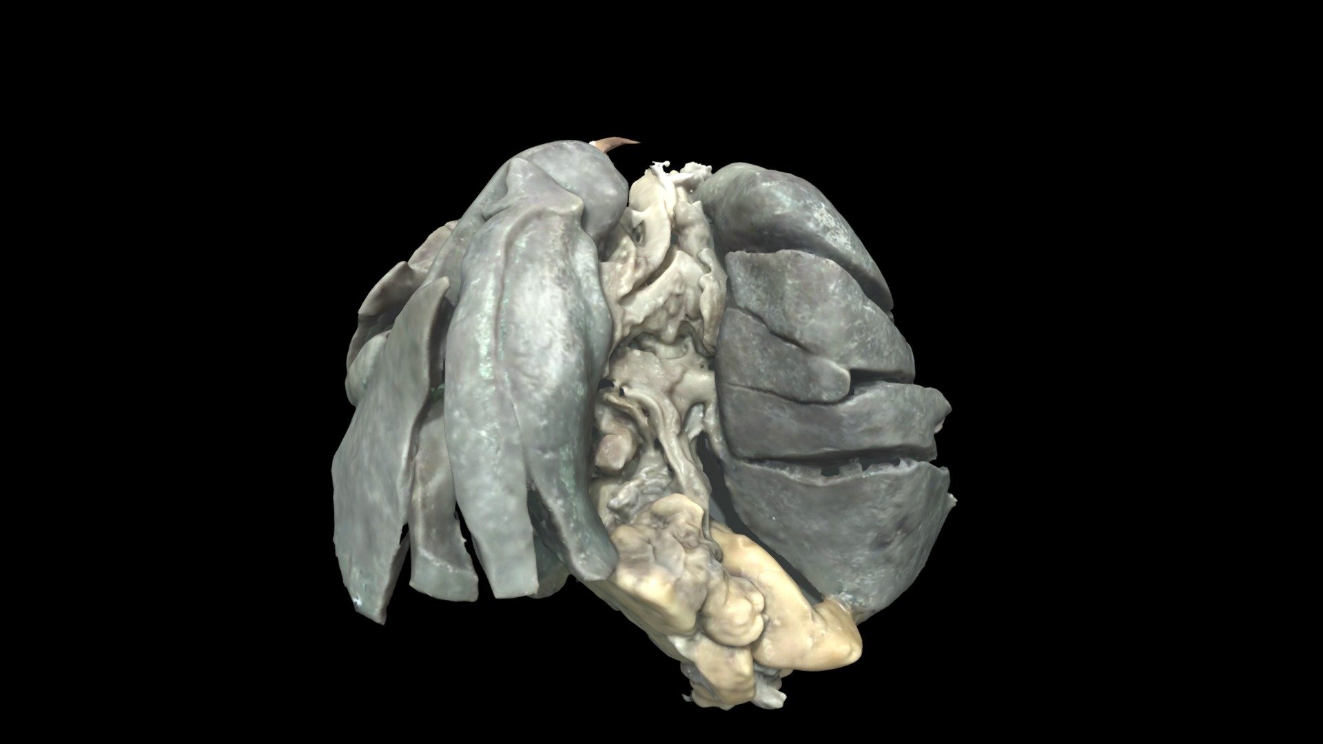 Total anomalous pulmonary veins I-745 - 3D model by Rohit Loomba ...