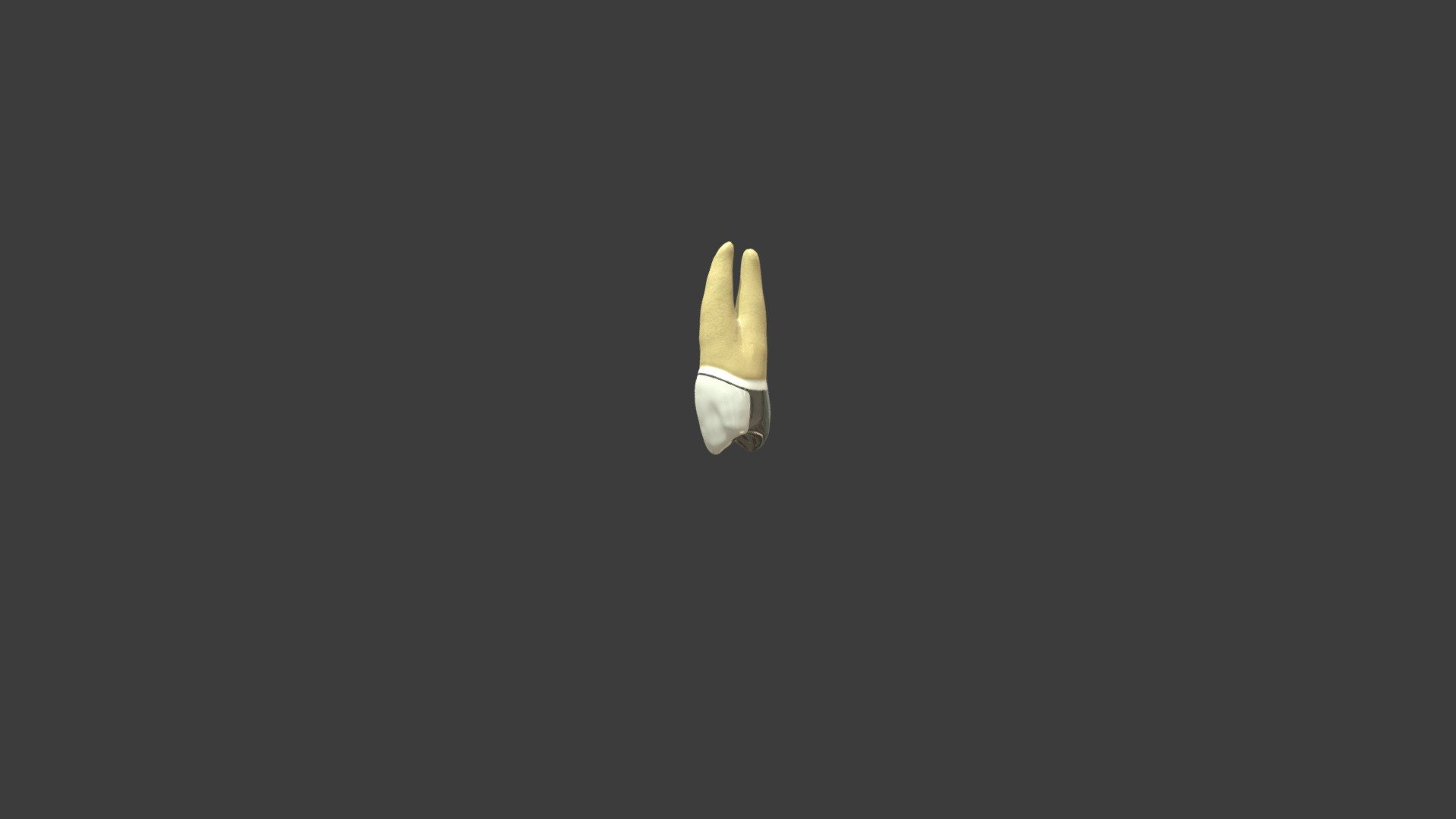 Premolar PFM Crown Preparation - 3D model by Ahmed Mahrous ...