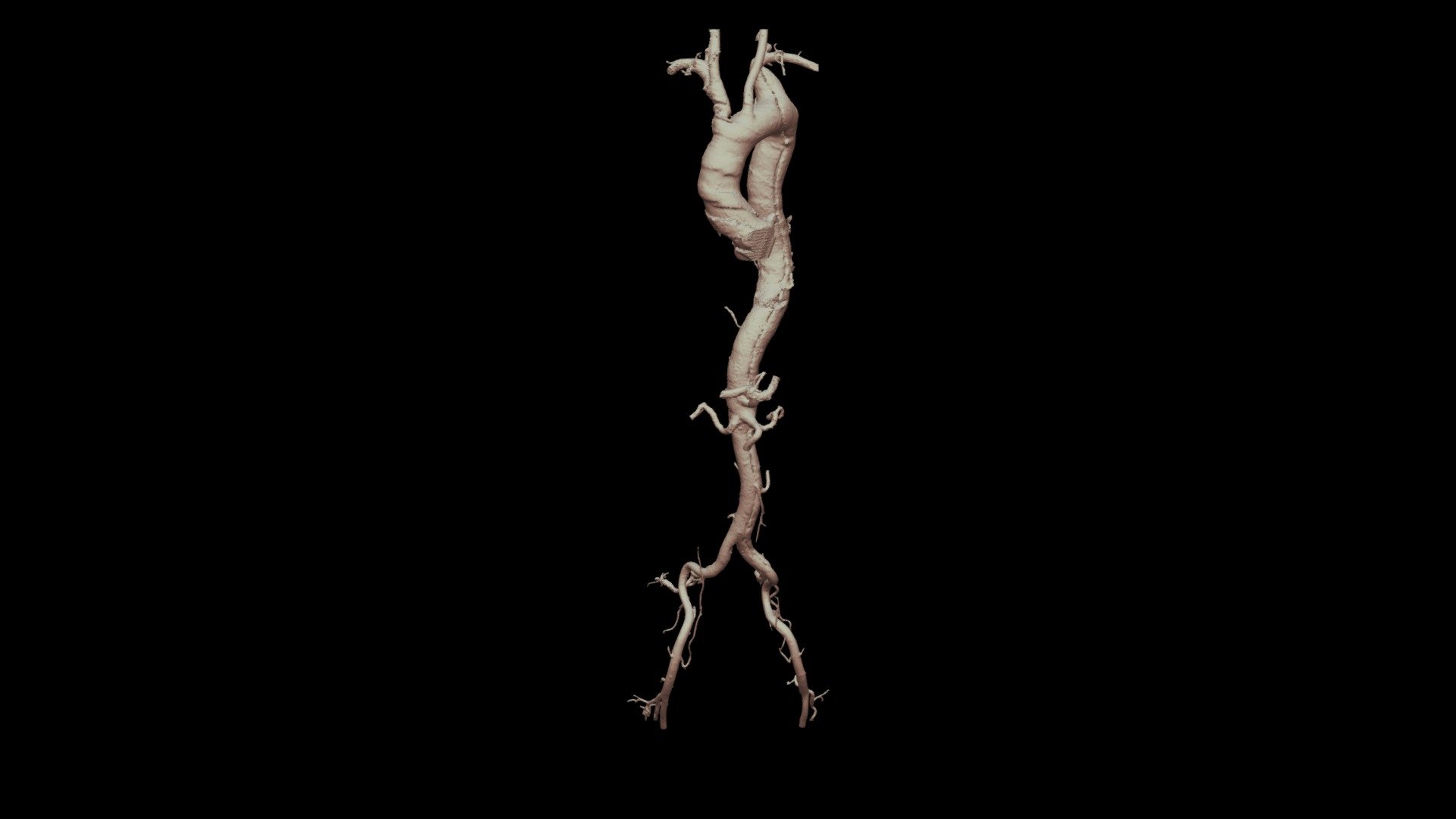 aorta prime - 3D model by Winston.Jaramillo [8ba9133] - Sketchfab