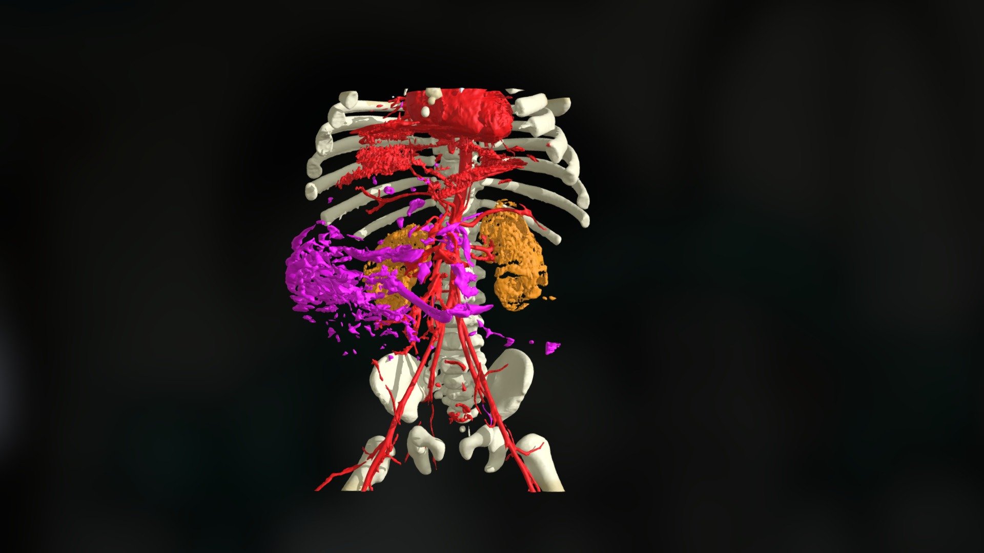 Fetus in fetu - 3D model by quequen [8bae2d5] - Sketchfab