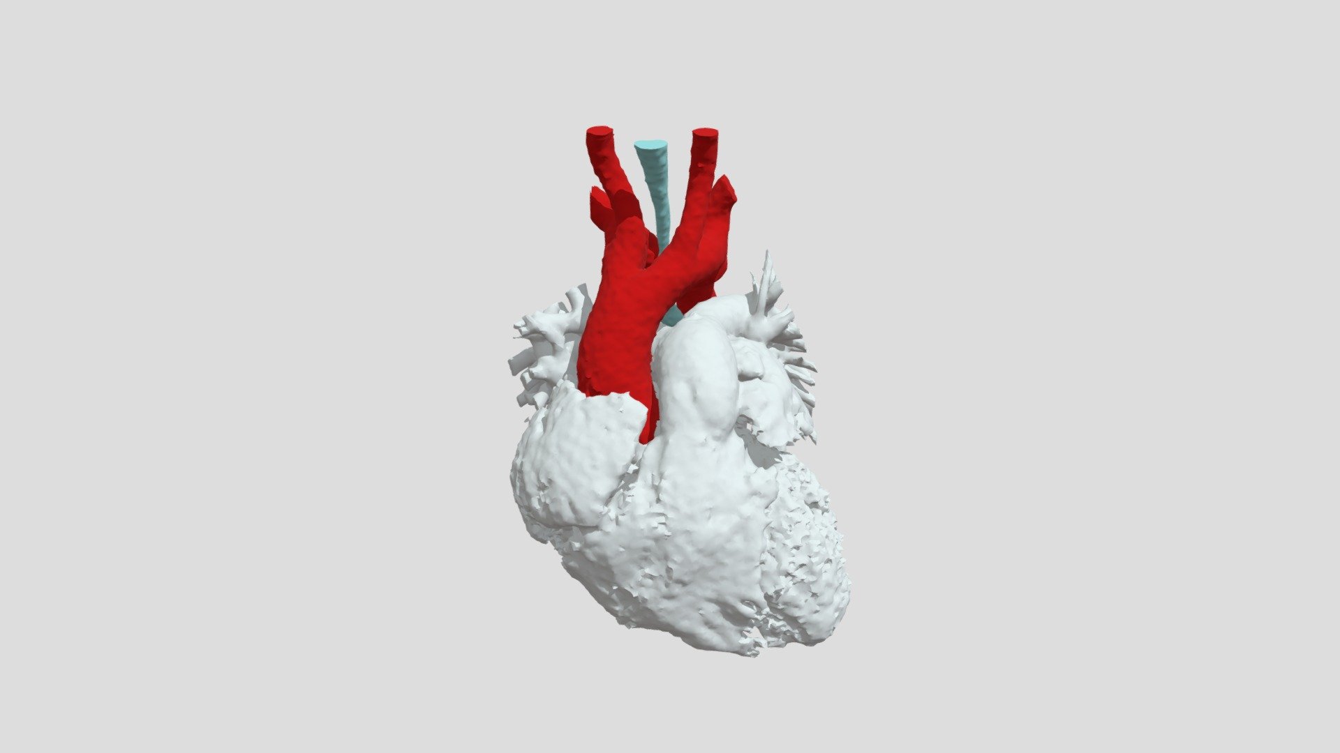 Double Aortic Arch (S0324) - 3D model by NCH Advanced Projects ...